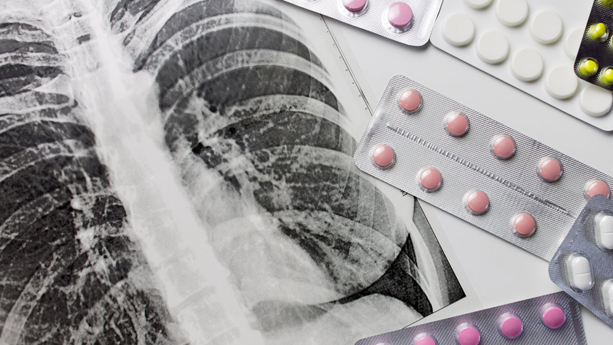 El Universal | Nuevas vacunas contra la Tuberculosis